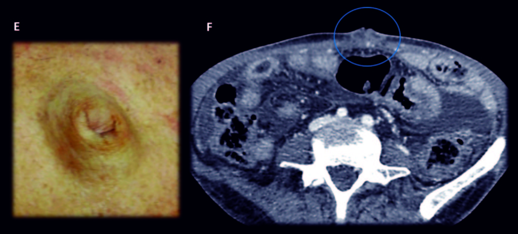 Sister Mary Joseph’s nodule: from the history to the images. A case ...