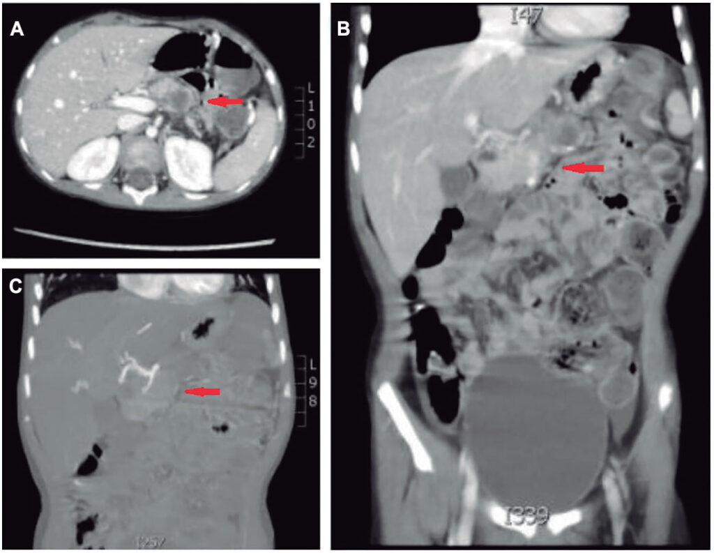 Pancreatoblastoma. Case report and review of literature