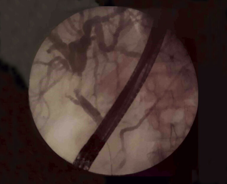 Mirizzi syndrome mimicking cholangiocarcinoma.Case report