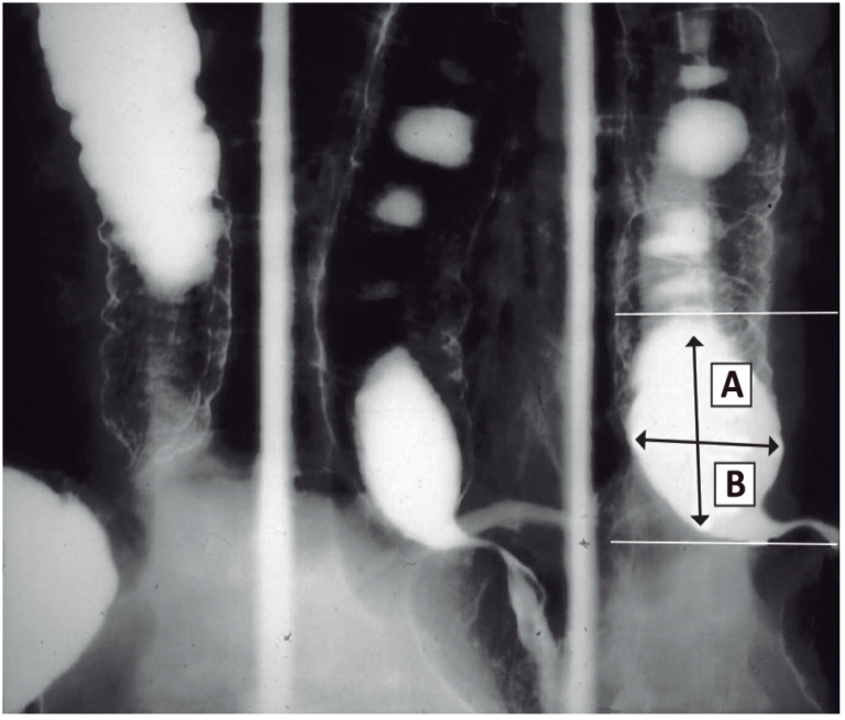 Acalasia: normas de manejo en base a las evidencias actuales