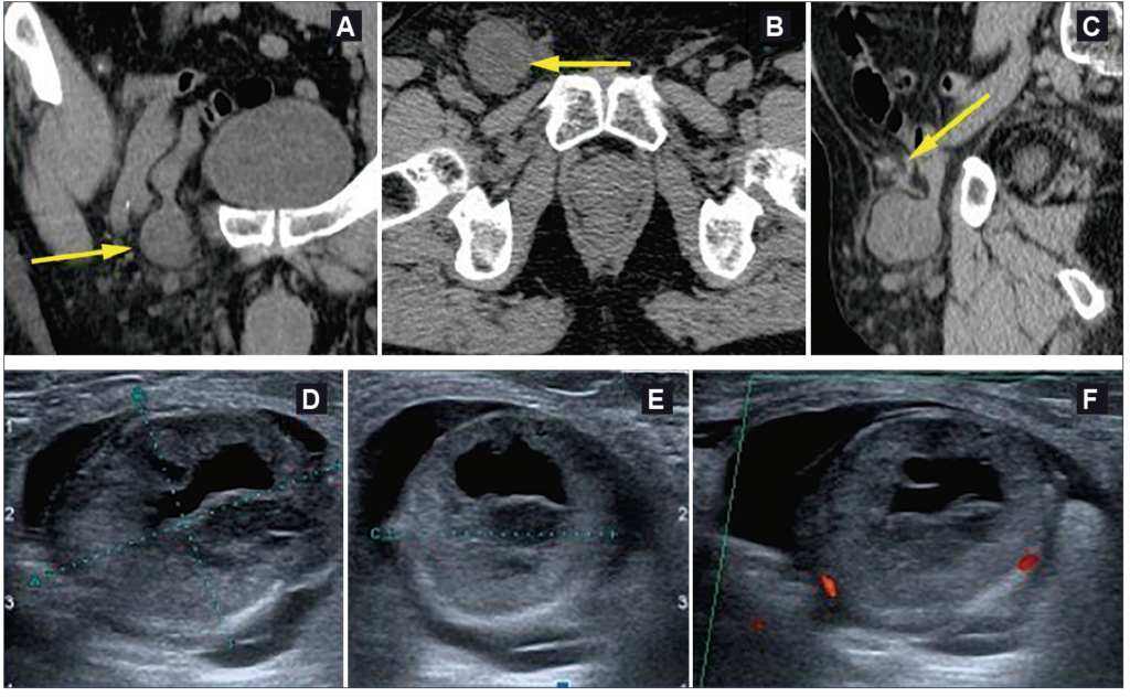 Hernia inguinal de contenido inusual: divertículode Meckel. Reporte de caso